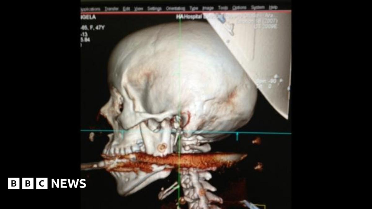 Brazilian woman survives harpoon shooting - BBC News