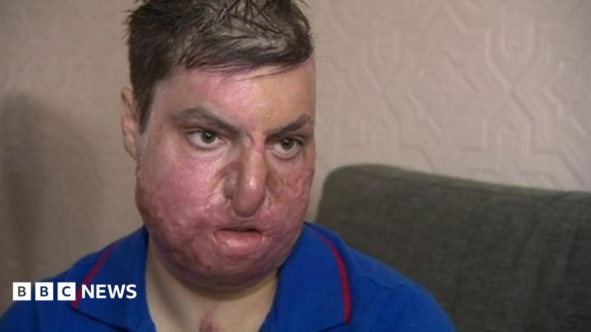 Salford plane crash survivor seeks damages to pay for face transplant ...