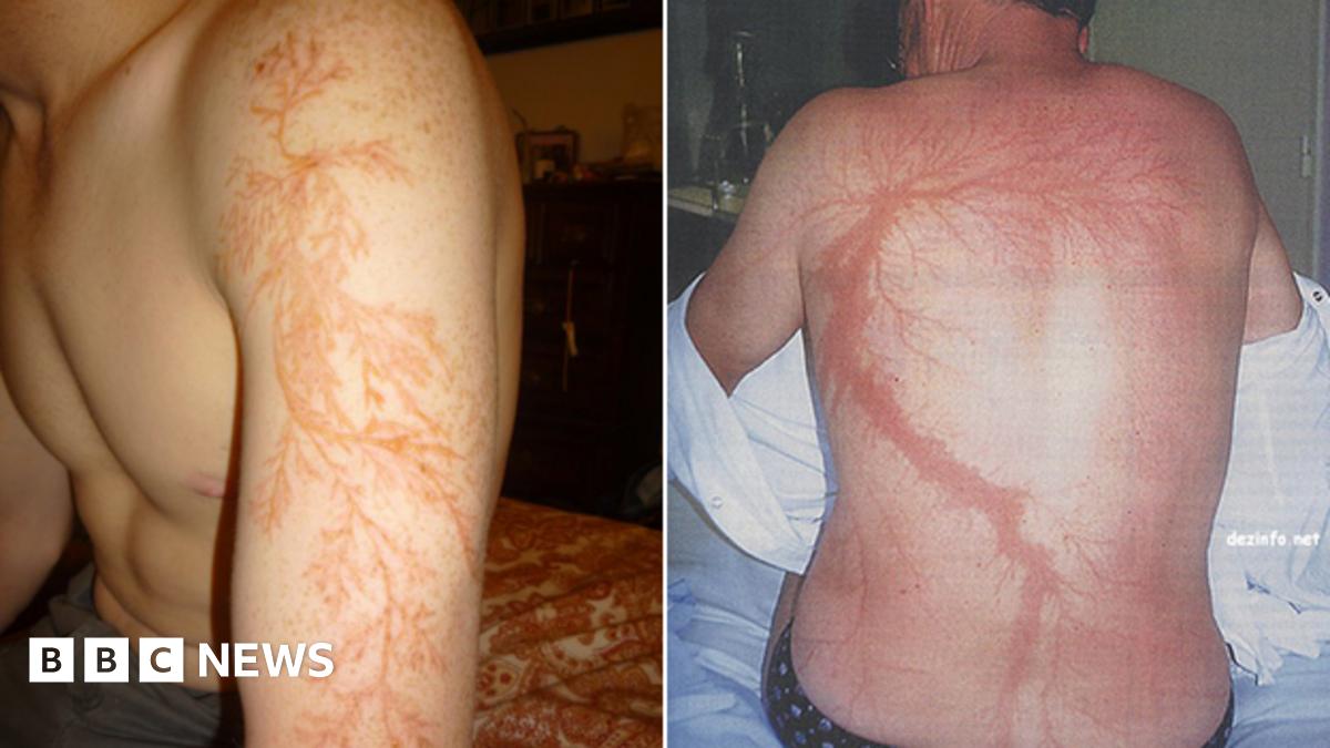 How do you recover from being struck by lightning? - BBC News