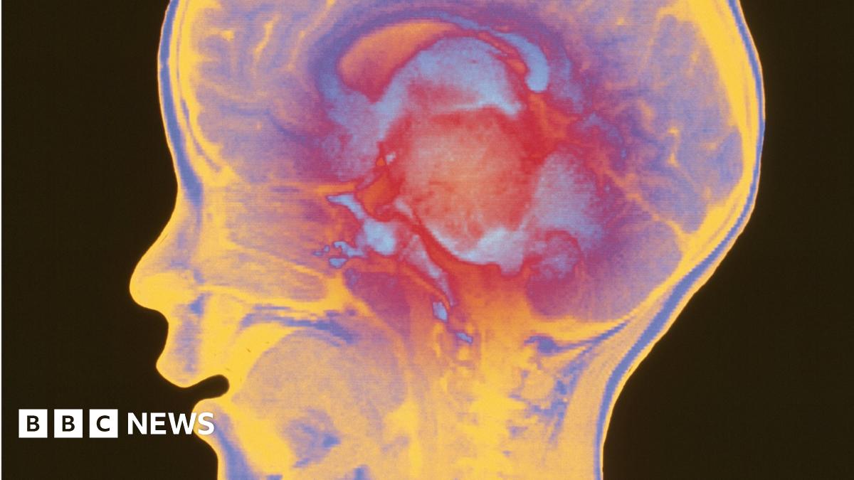 Dyslexia 'seen in brain scans' of pre-school children - BBC News