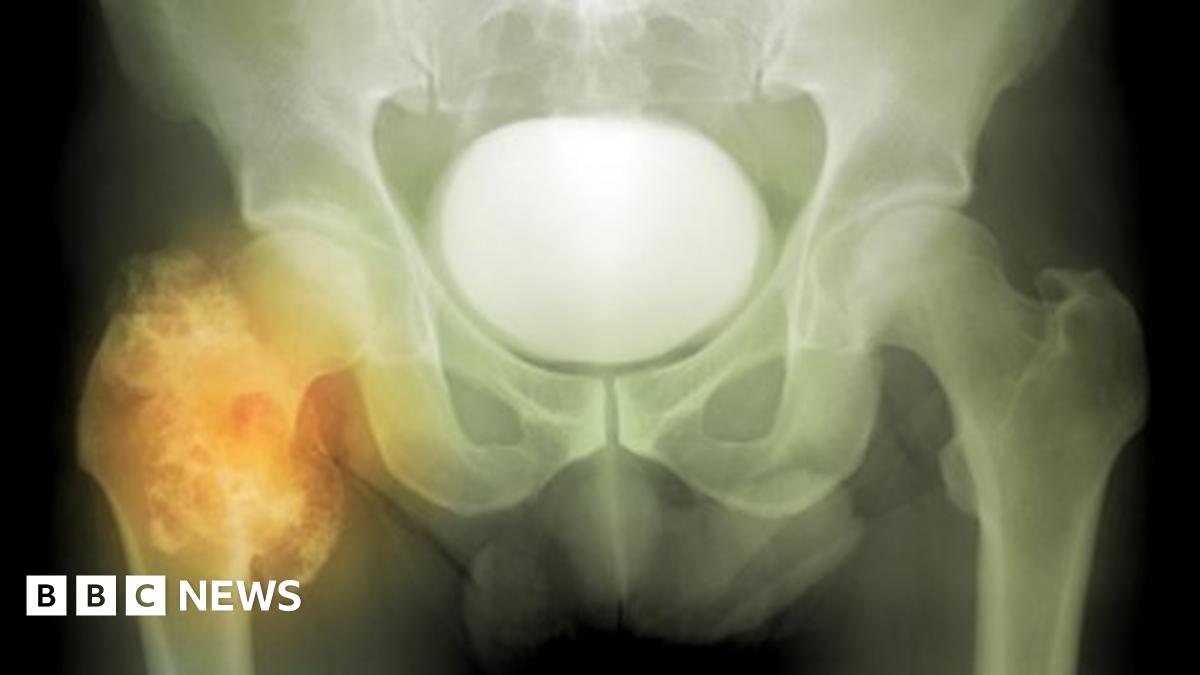 Call for early bone cancer diagnosis - BBC News