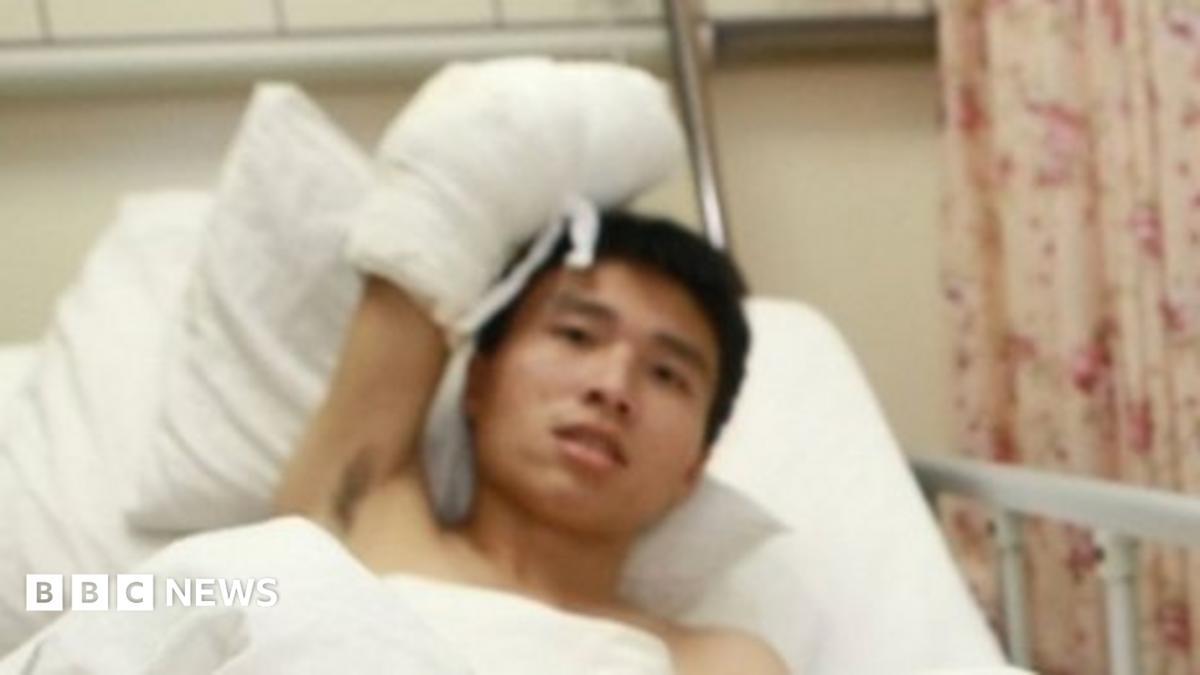 Severed hand kept alive on man's ankle - BBC News
