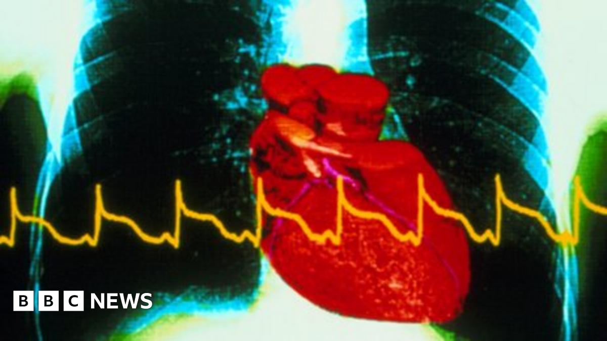 UK heart-attack survival rate 'should have been better' - BBC News