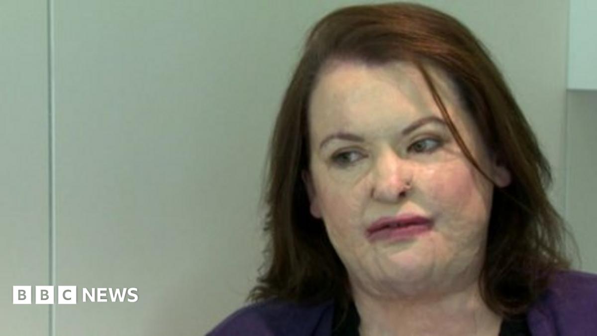 Second burns victim in NHS transplant call - BBC News