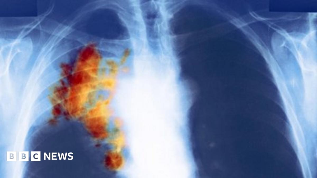 Lung cancer drugs trials start at Cardiff University - BBC News