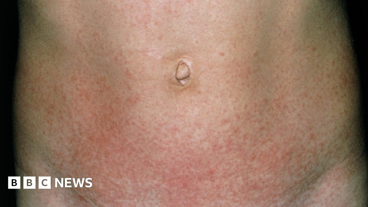 Scarlet fever cases rise to weekly high in England - BBC News
