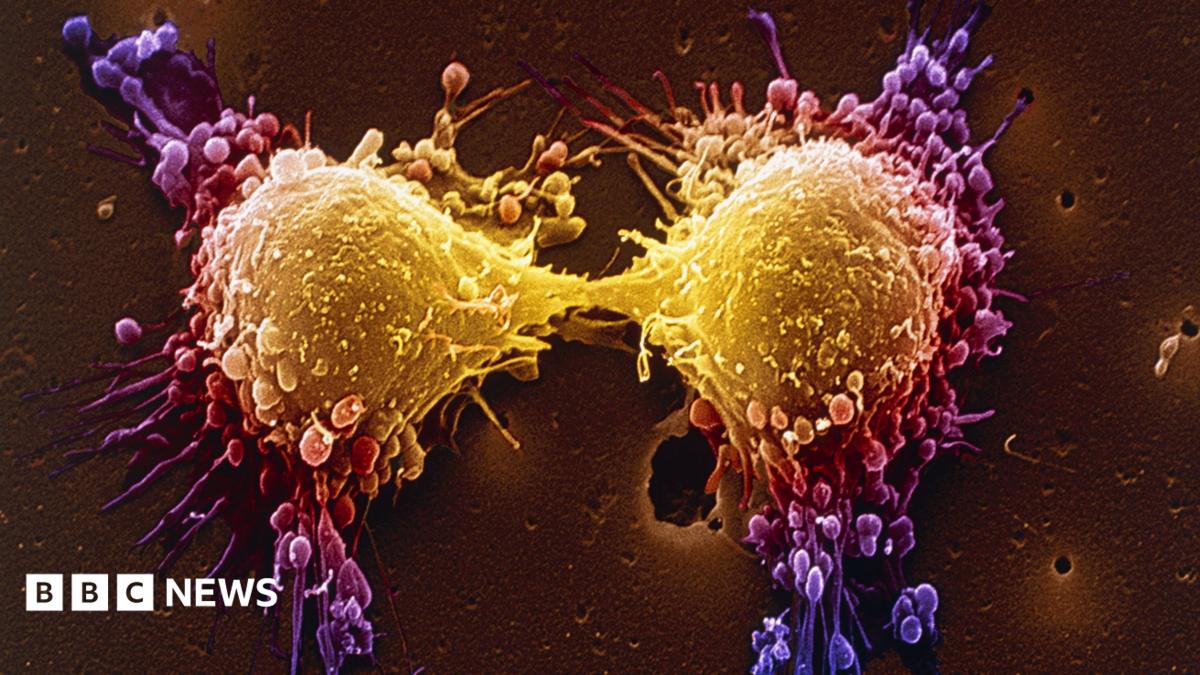 How often is prostate cancer misdiagnosed? - BBC News