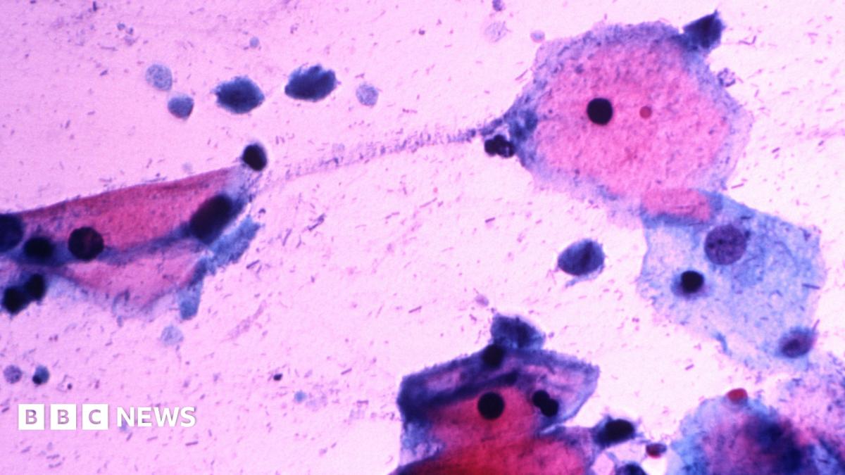 Prostate cancer 'may be a sexually transmitted disease' - BBC News