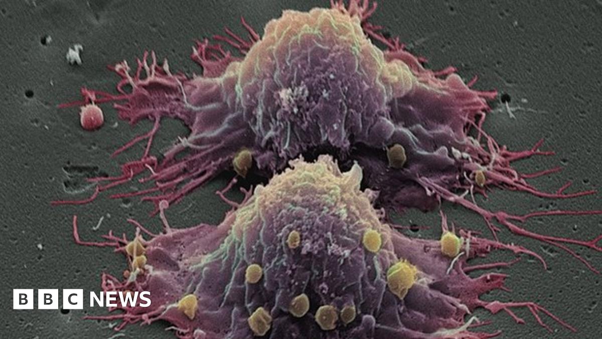 A new technique for detecting bowel cancer to be trialled in parts of ...