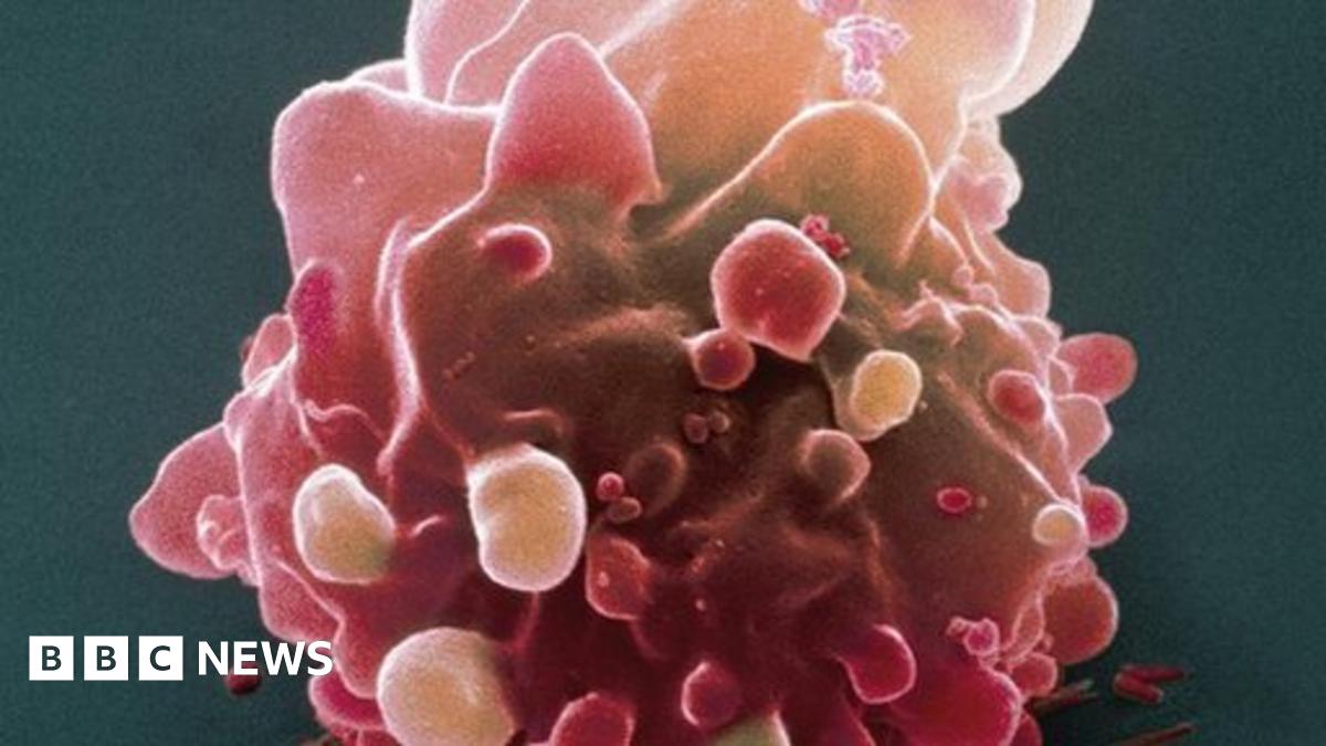 Wales' bowel surgery death rate 'higher than expected' - BBC News