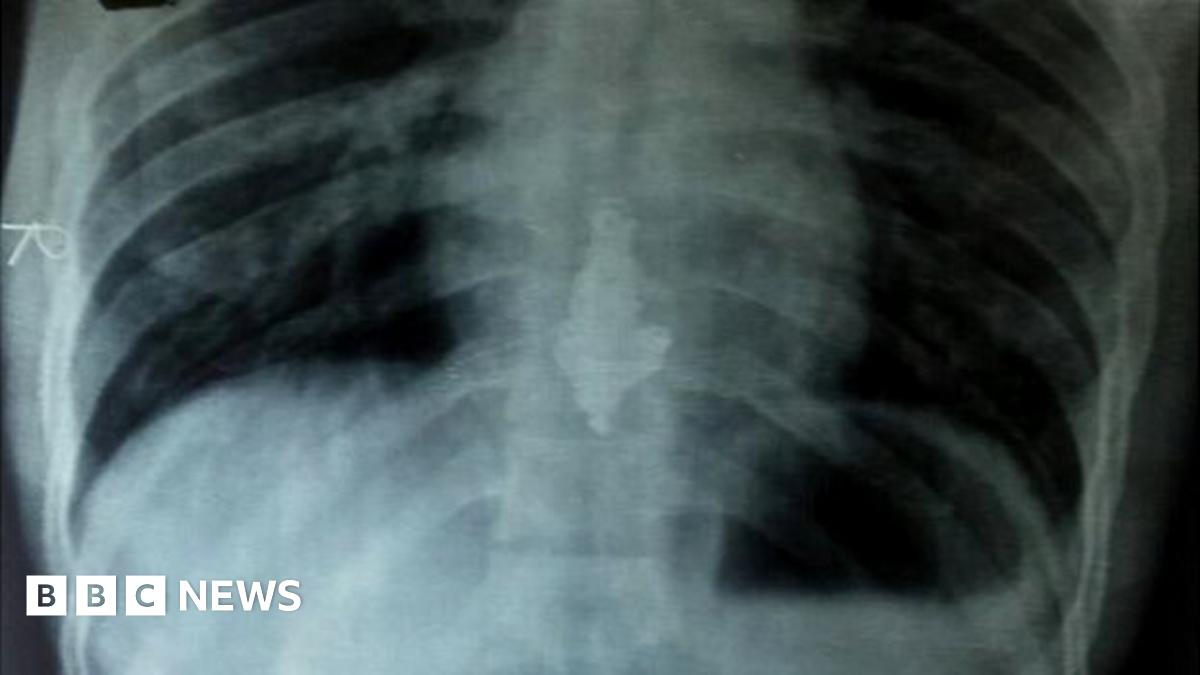 Indian 'thief' expels gold necklace after 60 bananas - BBC News