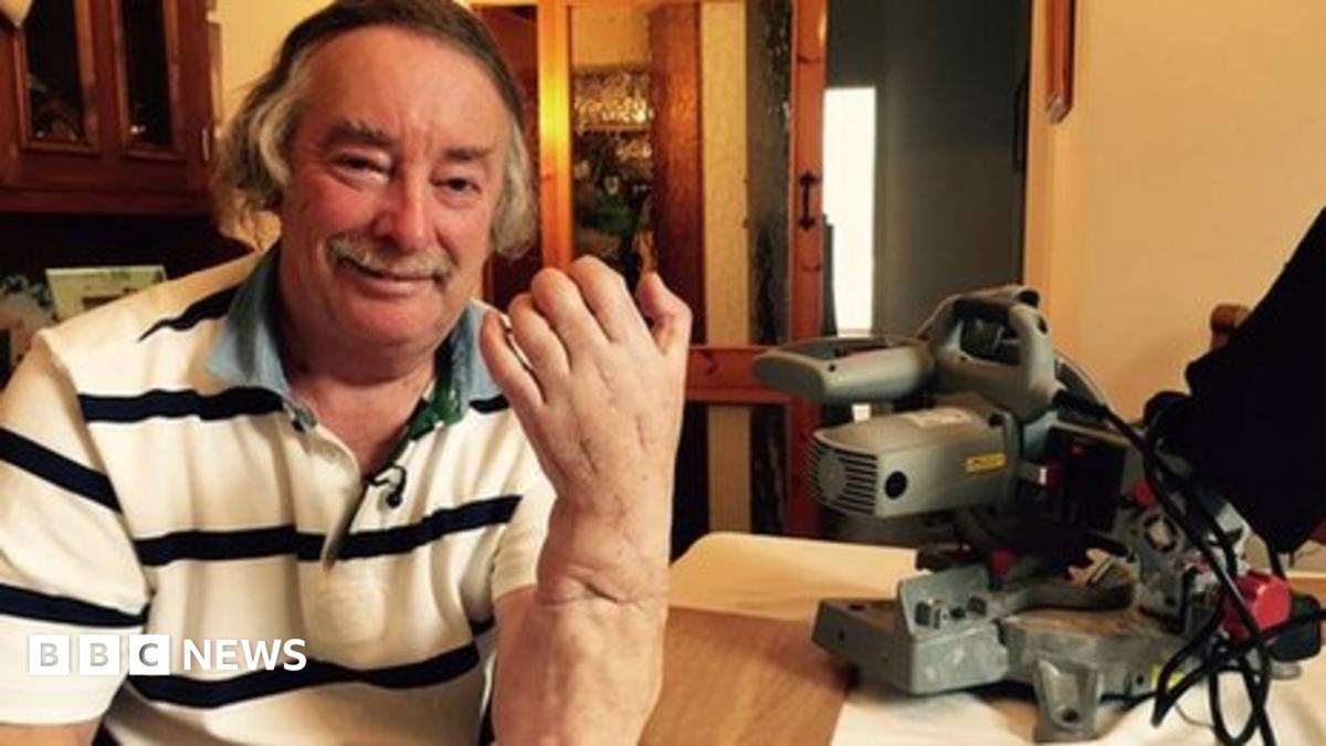 Man's hand reattached after DIY accident with circular saw - BBC News