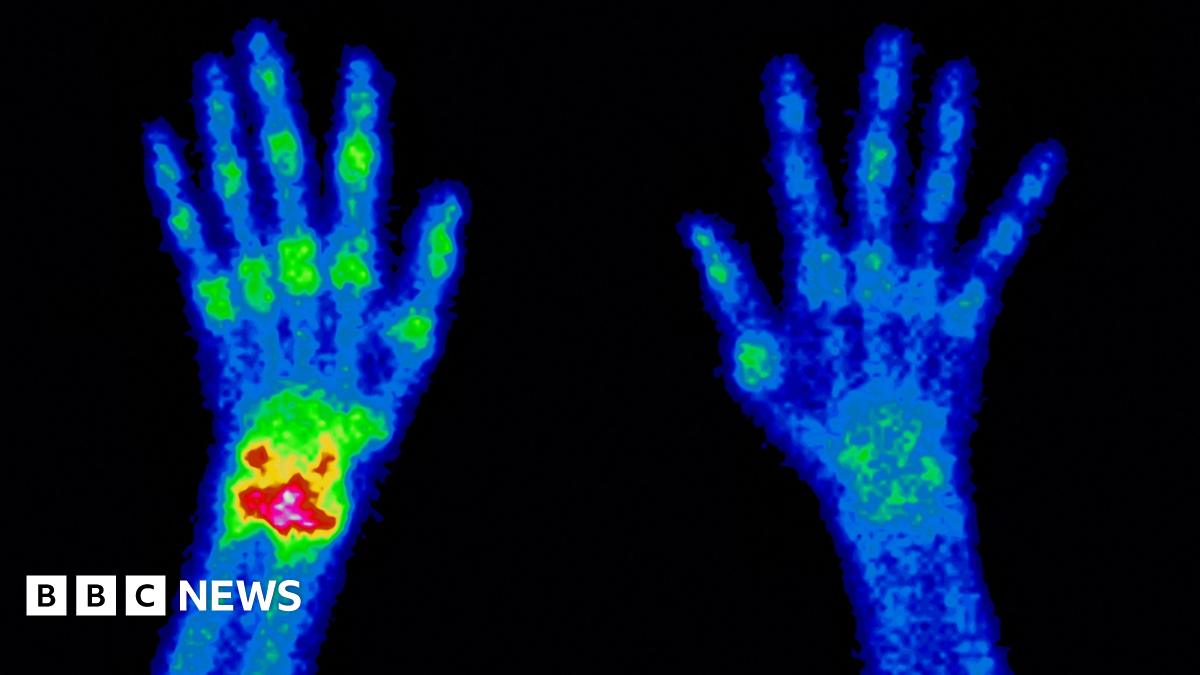 The element that can make bones glow - BBC News