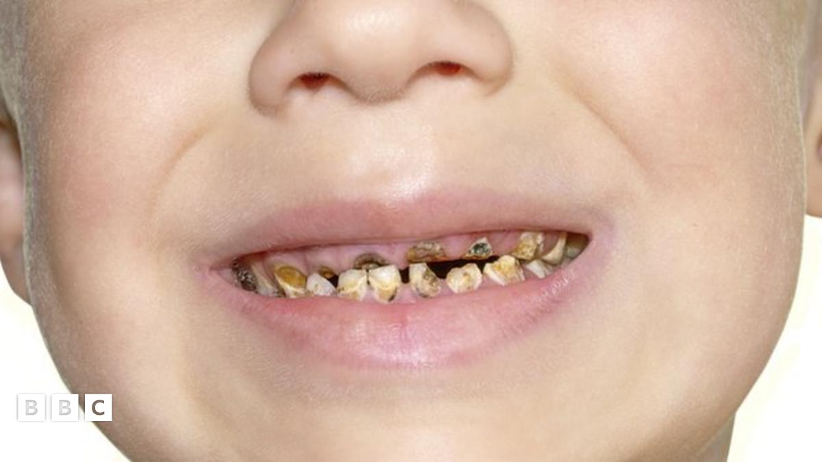 Parents 'should supervise or brush children's teeth' until age of 14 ...