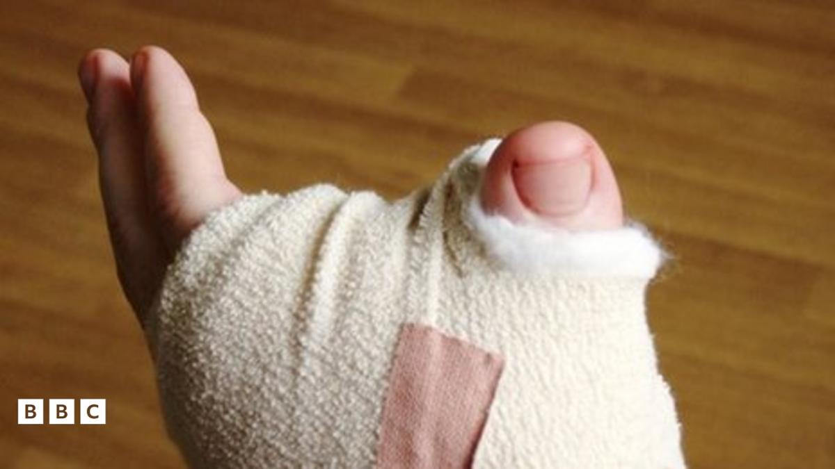 Doctors use big toe to replace man's thumb - BBC Newsround
