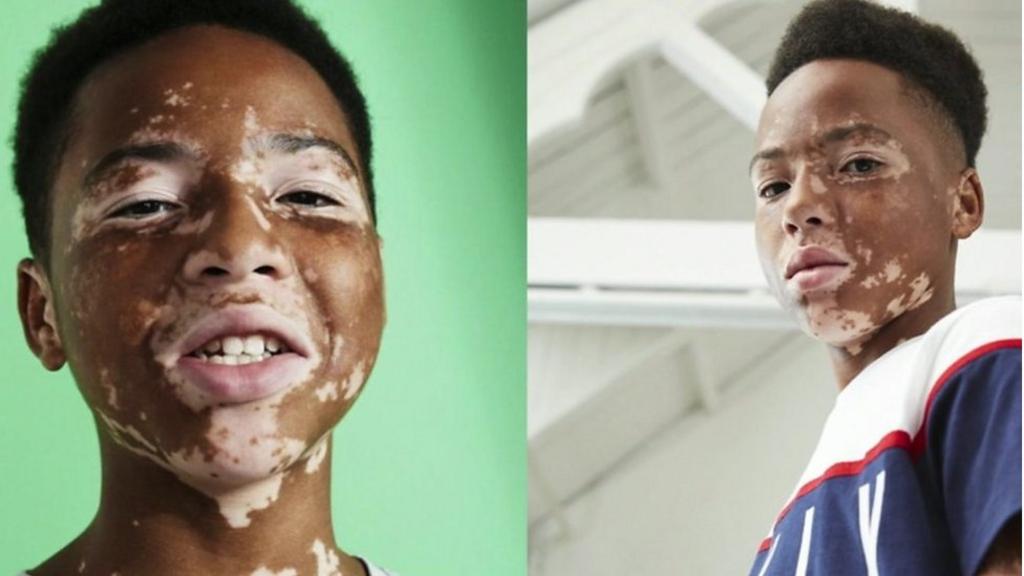 Meet the model with vitiligo who is making a difference - BBC Newsround