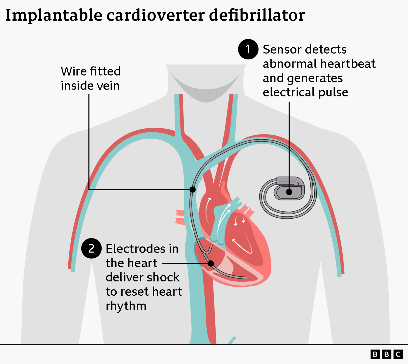 How Christian Eriksen's heart device kicked into action - BBC News