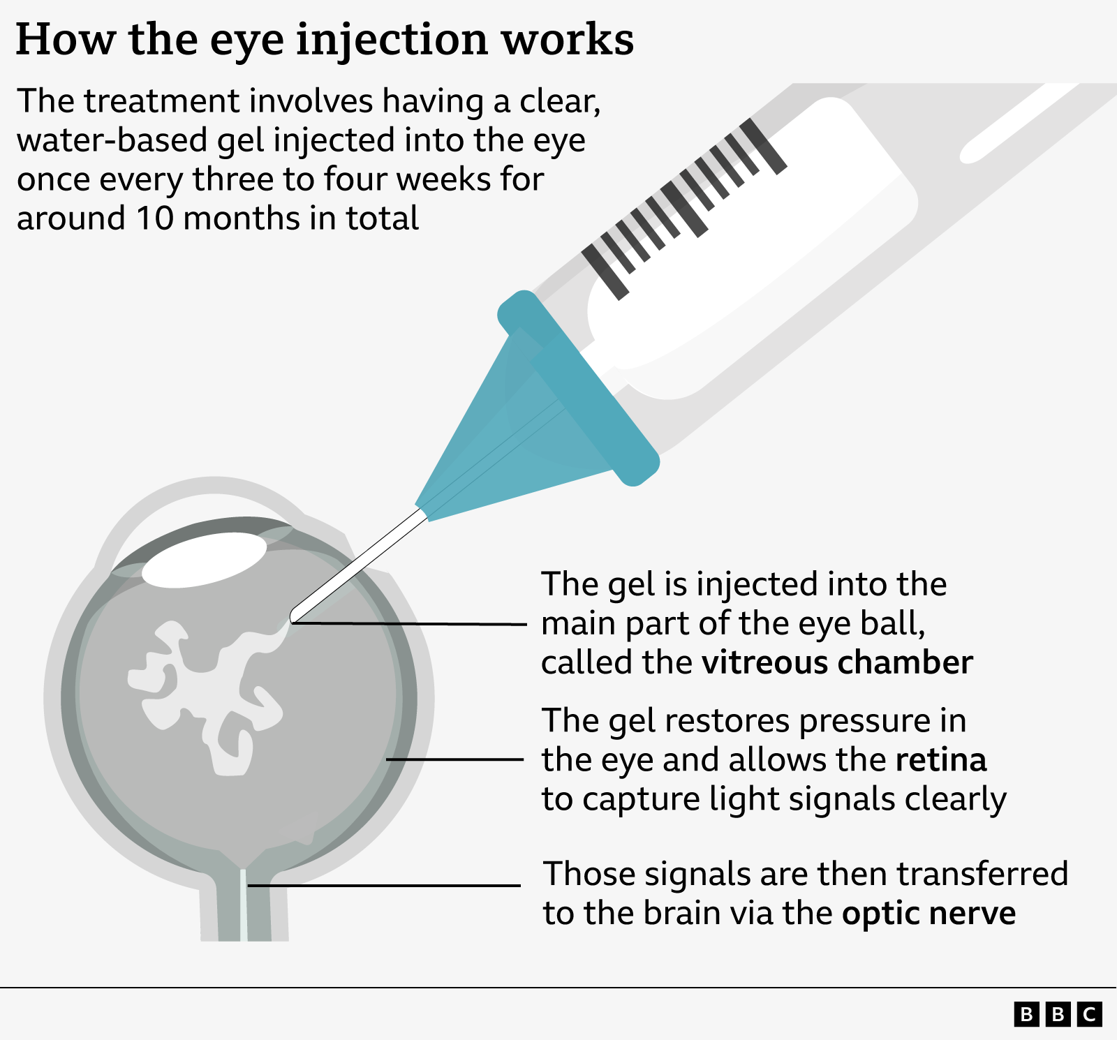 Revolutionary eye injection saved my sight, says first ever patient ...