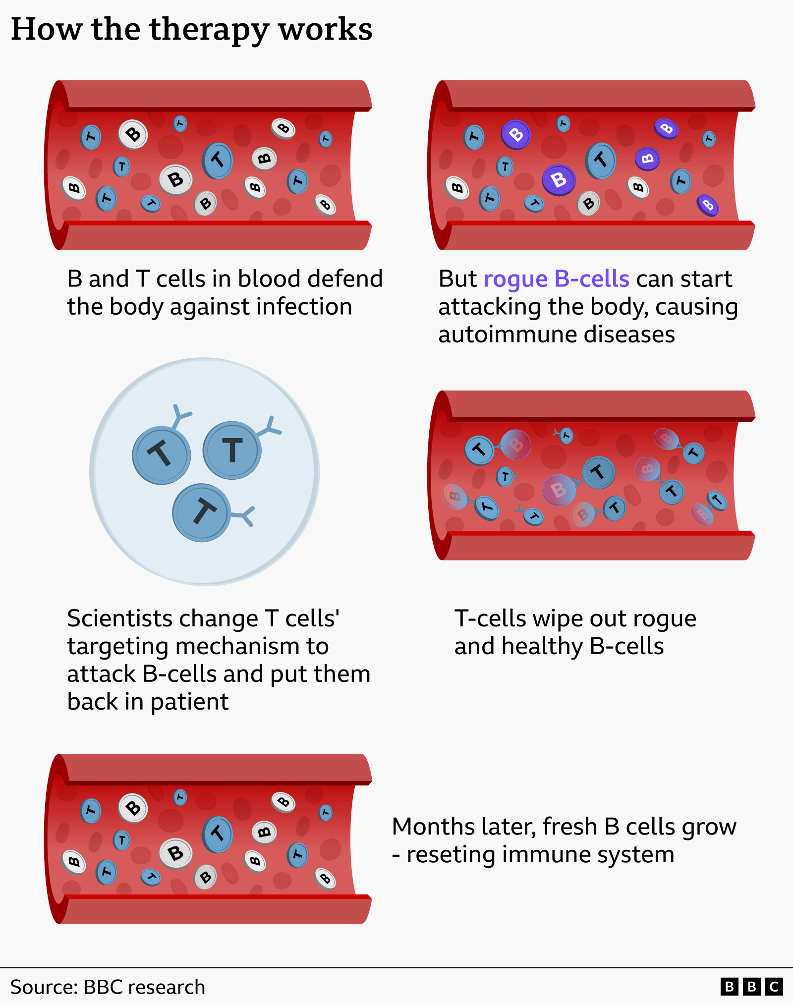 'I've never been this good' - revolutionary immune reset puts lupus in ...