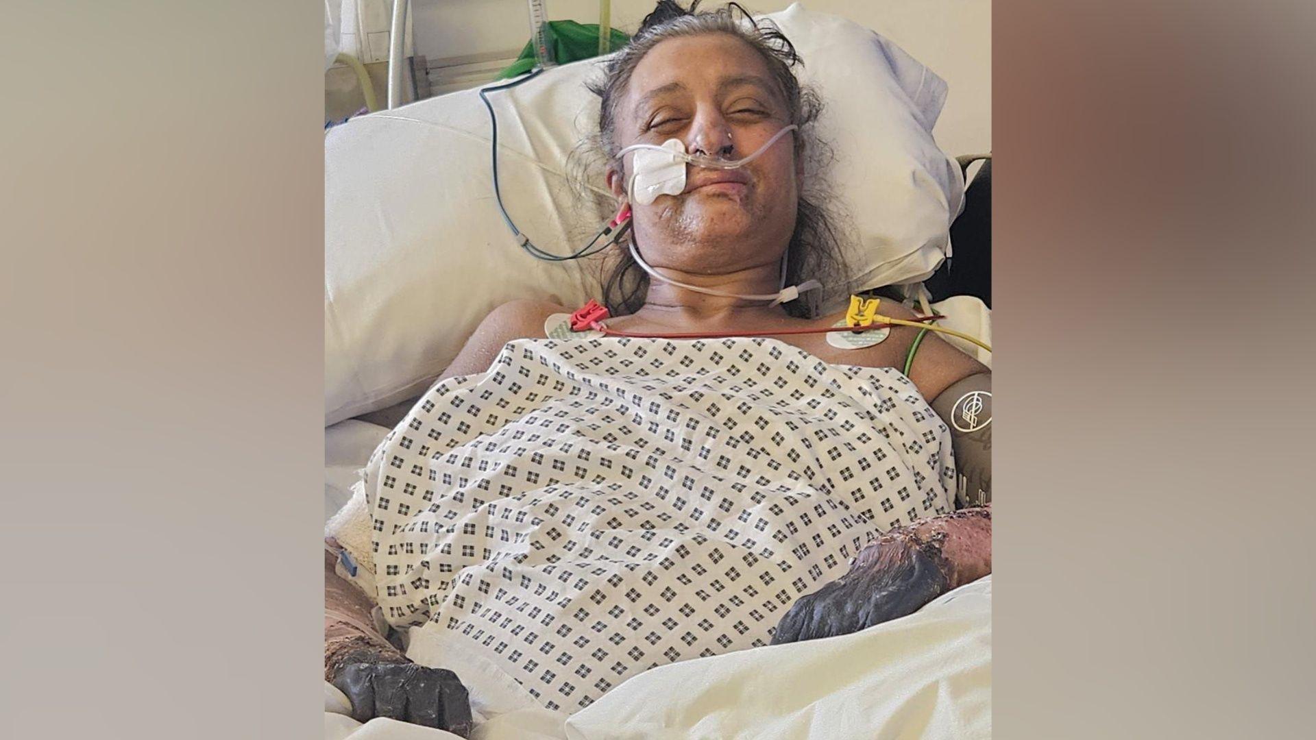 Sepsis warning after Penn woman's quadruple amputation - BBC News