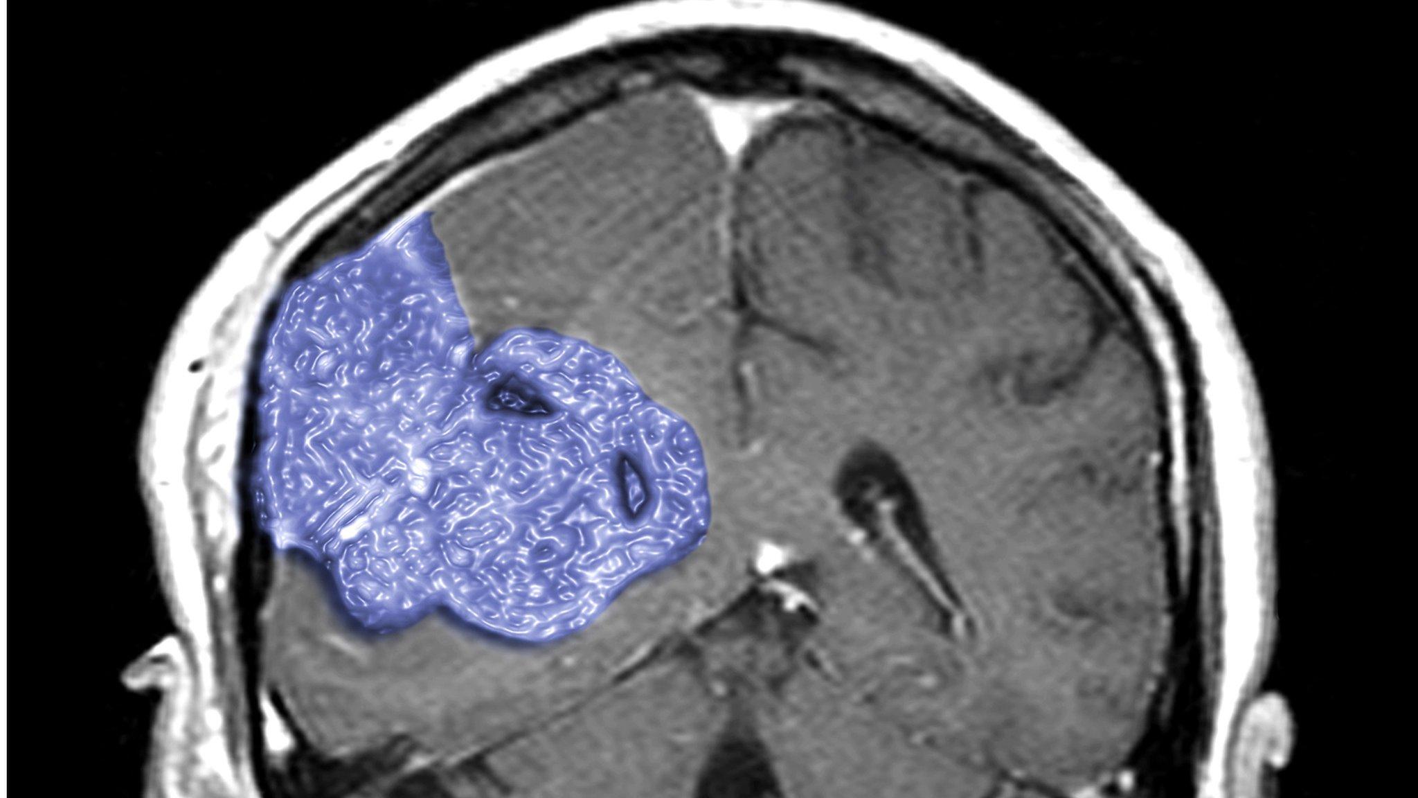 Cancer-killing stem cells engineered in lab - BBC News