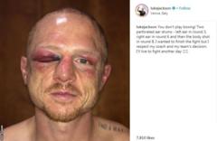 Luke Jackson: Australian boxer reveals injuries after Carl Frampton ...