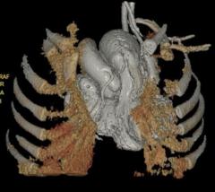 'One-of-a-kind' girl born with heart outside chest has pioneering ...