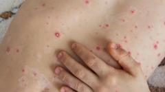 What is chickenpox and who can get the NHS vaccine? - BBC News