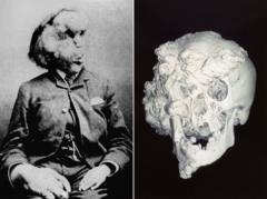 Unlocking the secrets of the Elephant Man - BBC News