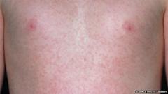 Rubella (German measles) eradicated from Americas - BBC News