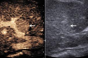 Child cancer: 'Field of gold' scan cuts radiation risk - BBC News