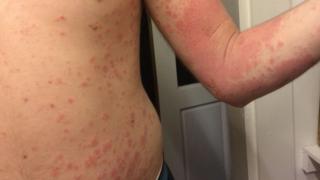 Living hell for 'forgotten' South West skin patients - BBC News