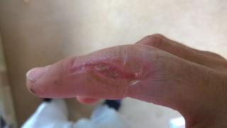 'My fingers were almost cut off by a drone' - BBC News