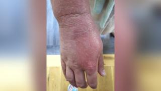 National eczema week: 'I wanted to rip my skin off' - BBC News