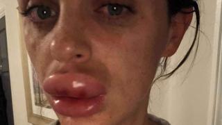 Mental Health: Tougher checks before Superdrug Botox - BBC News