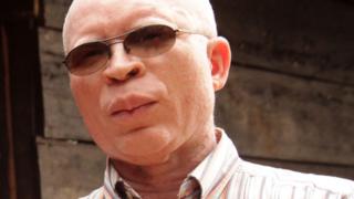 Somalis with albinism: Pelted with stones and raw eggs - BBC News