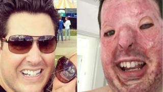 Truro acid attack victim Andreas Christopheros calls for law changes ...