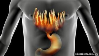 Ulcer drugs linked to vitamin B12 deficiency - BBC News