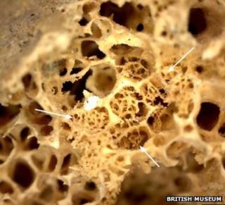Ancient skeleton is the earliest case of cancer yet detected - BBC News