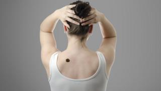 Skin cancer rates in Scotland 'soar' since 1970s - BBC News