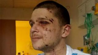 Scalded husband: 'No shame' for male domestic abuse victims - BBC News