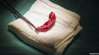 The man who cut out his own appendix - BBC News