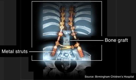 Pioneering surgery repairs girl's spine with leg bone - BBC News