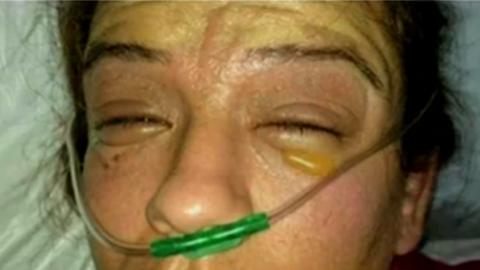 Chemical weapons and Islamic state: What is mustard gas? - BBC News