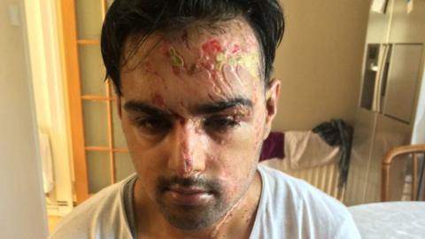 Acid victim Samir Hussain 'relives attack every day' - BBC News