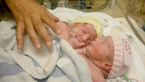 Twins conjoined at birth prepare to start school - BBC News