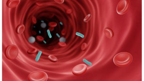 My limbs were amputated after sepsis, says MP Craig Mackinlay - BBC News