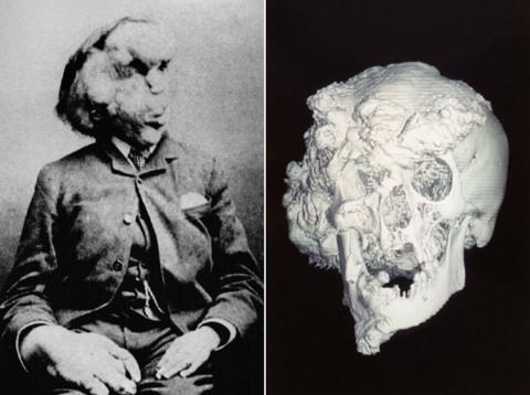 Unlocking the secrets of the Elephant Man - BBC News