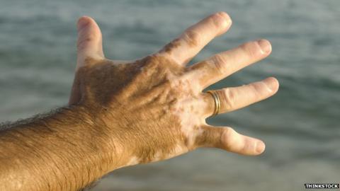Who, What, Why: How common is skin pigment condition vitiligo? - BBC News