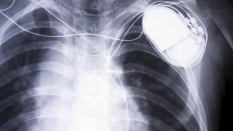 Medical devices vulnerable to hackers - BBC News
